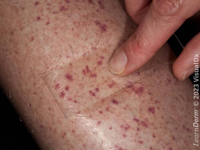 Diascopy | The Skin Exam | Lessons - LearnDerm