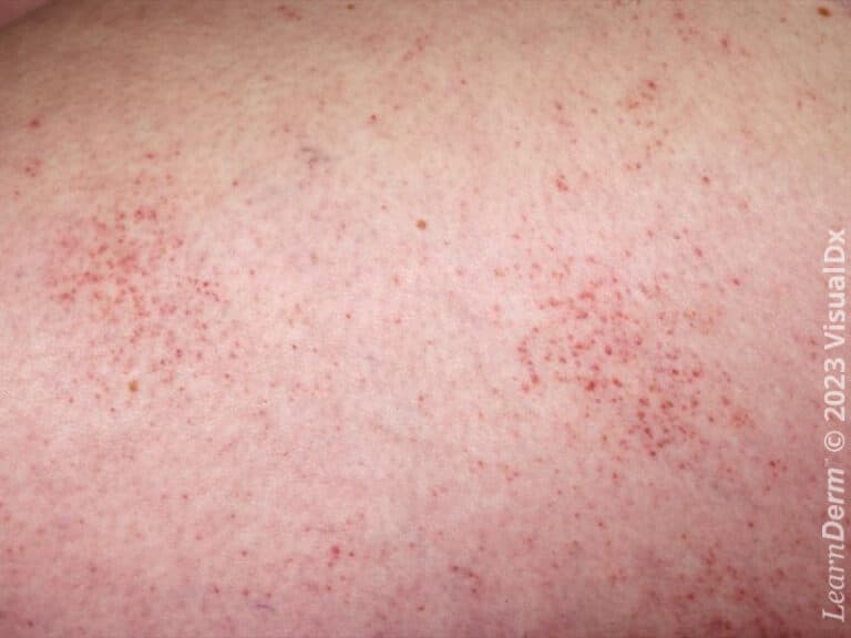 Petechiae LearnDerm