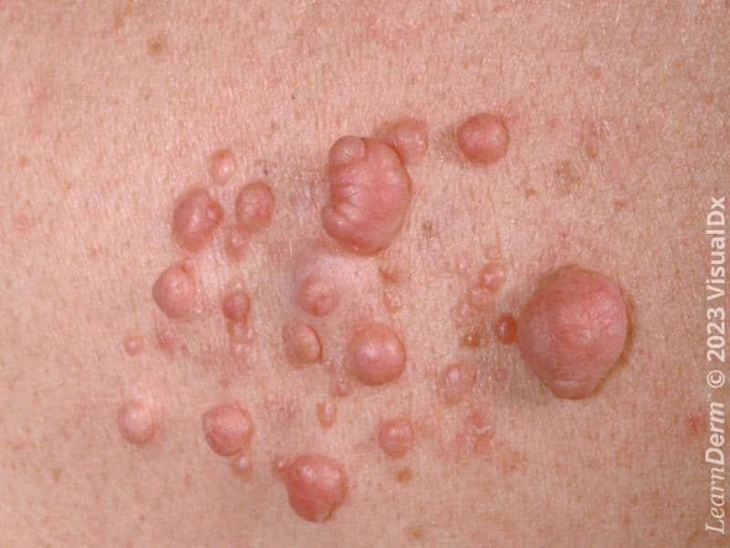 Nodule LearnDerm Nodule LearnDerm