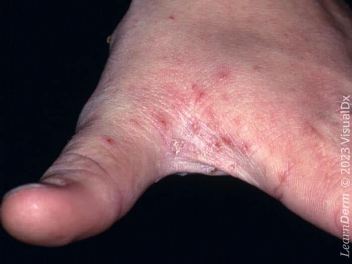 Hand - LearnDerm