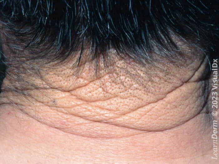 Neck - LearnDerm