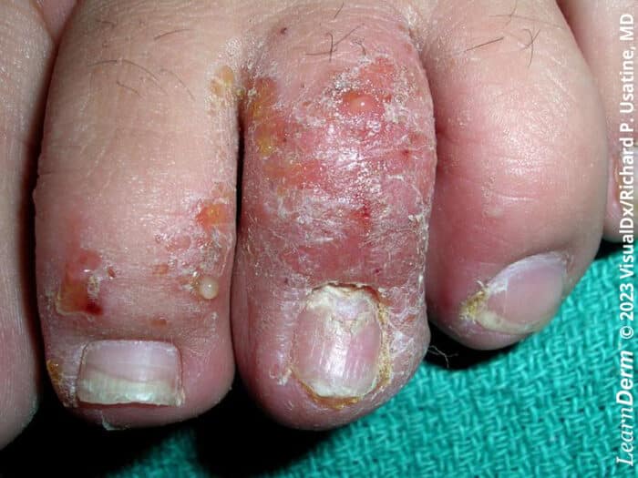 morphology | distribution | Lessons - LearnDerm