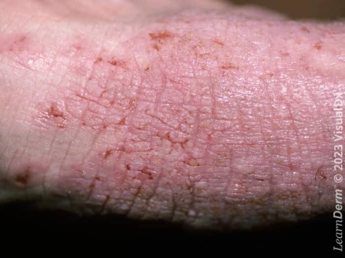 Pruritis | Inflammation | Lessons - LearnDerm