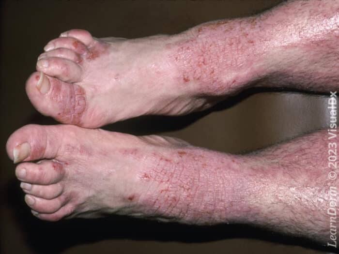 morphology | distribution | Lessons - LearnDerm