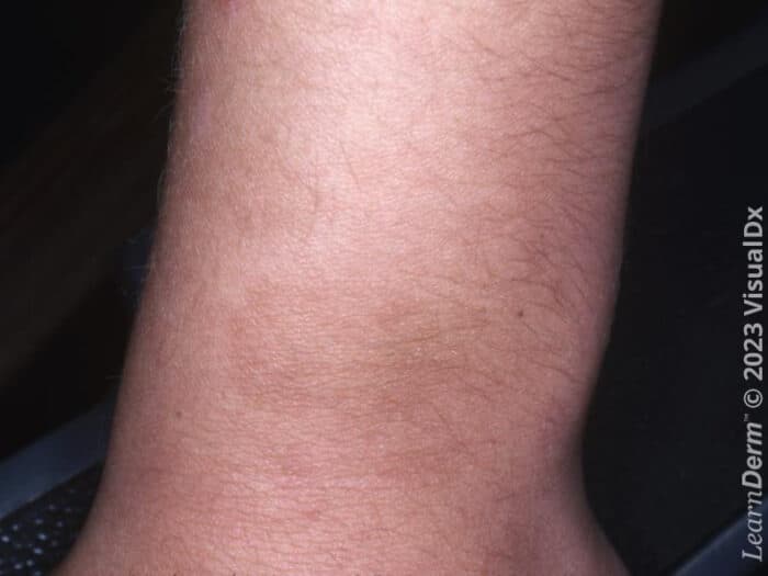 Dyschromia | distribution | Lessons - LearnDerm