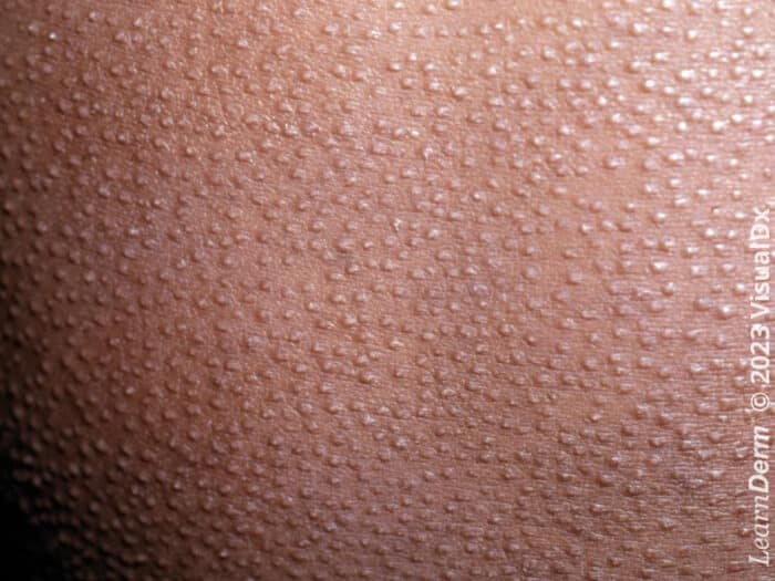 Dyschromia | distribution | Lessons - LearnDerm